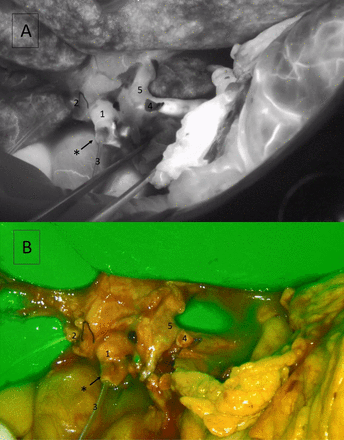 Brightening the path to safe liver transplants: the role of ICG ...